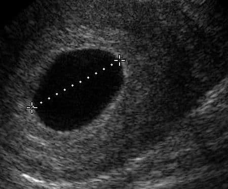 The Gestational Sac In Pregnancy